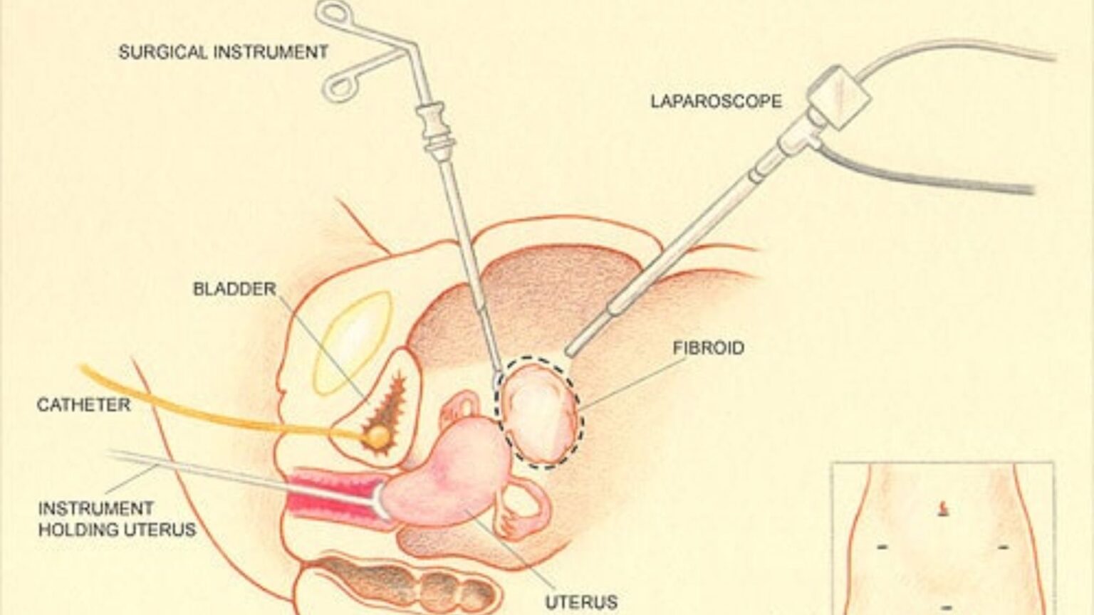 Laparoscopic Myomectomy: Minimally Invasive Fibroid Removal Surgery ...