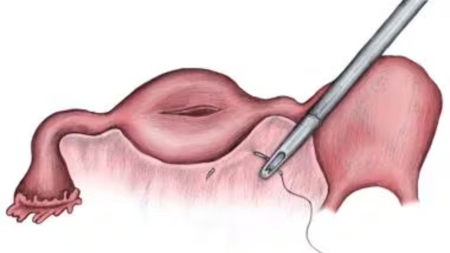 Laparoscopic Surgery for Ectopic Pregnancy: Minimally Invasive ...
